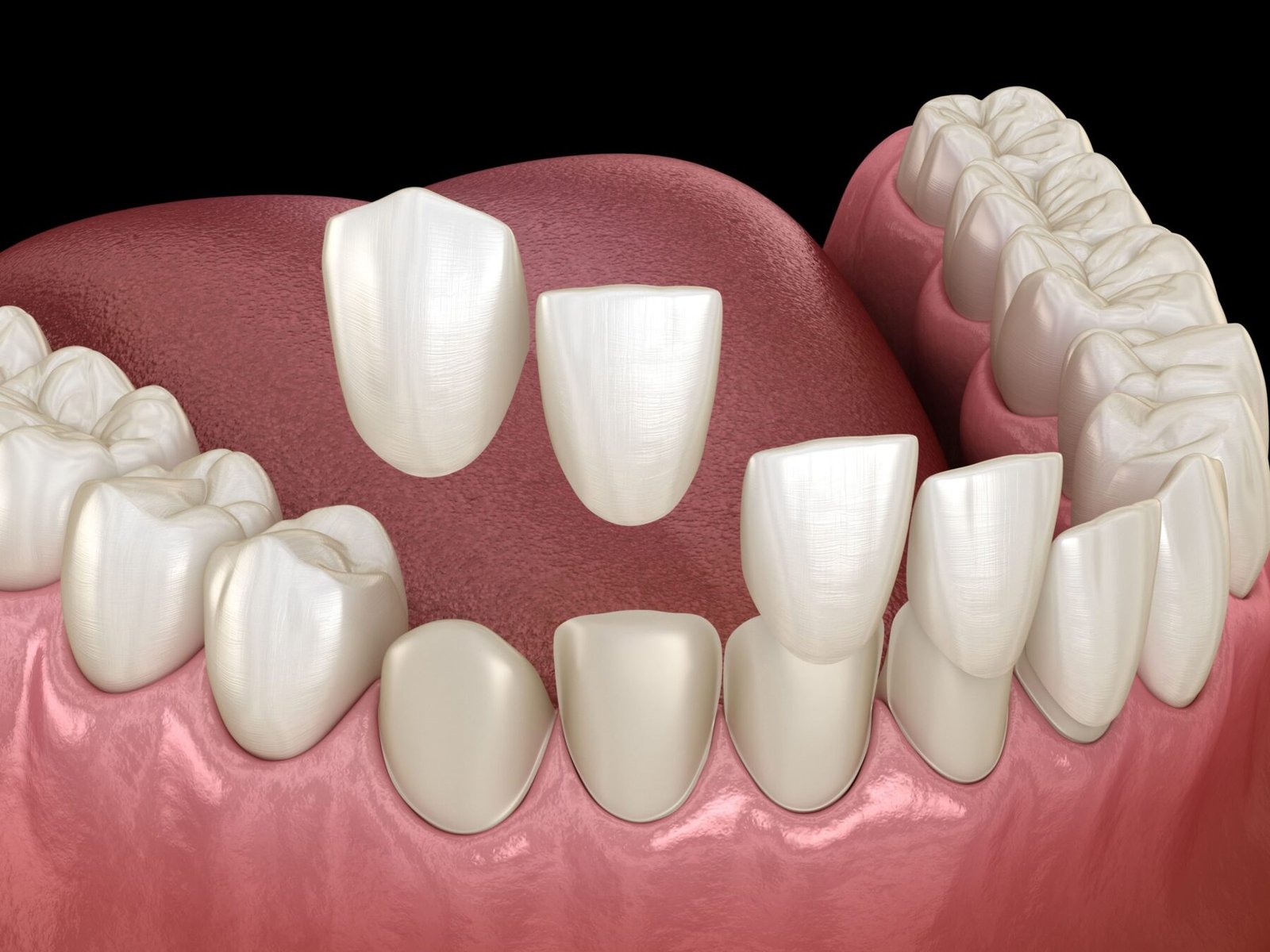 Composite Bonding vs. Porcelain Veneers: Which Is the Right Choice for You? – Peterhead Dental ...